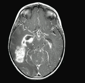 A Girl With Streptococcus dysgalactiae Brain Abscess and Meningitis | Consultant360